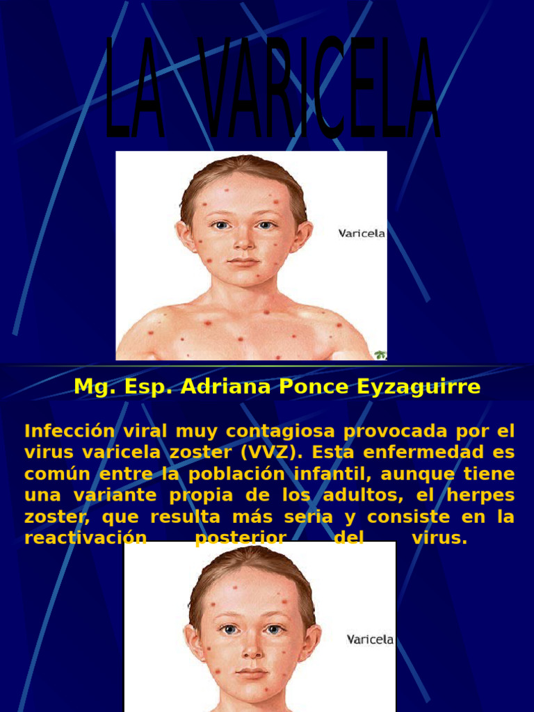 varicela | PDF