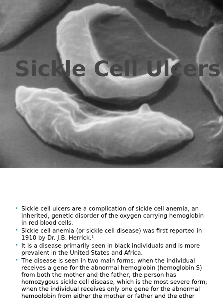 Sickle Cell Ulcers: Causes and Treatment | PDF | Wound | Anemia
