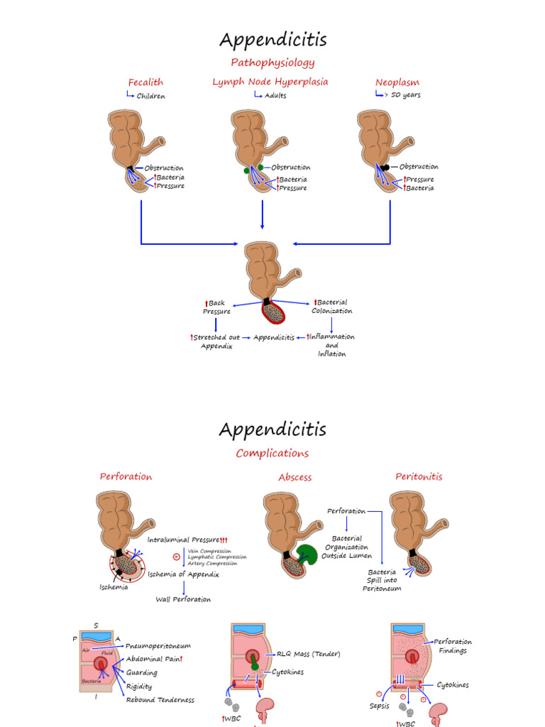 16• Appendicitis [Illustrations Key] | PDF | Diseases And Disorders ...