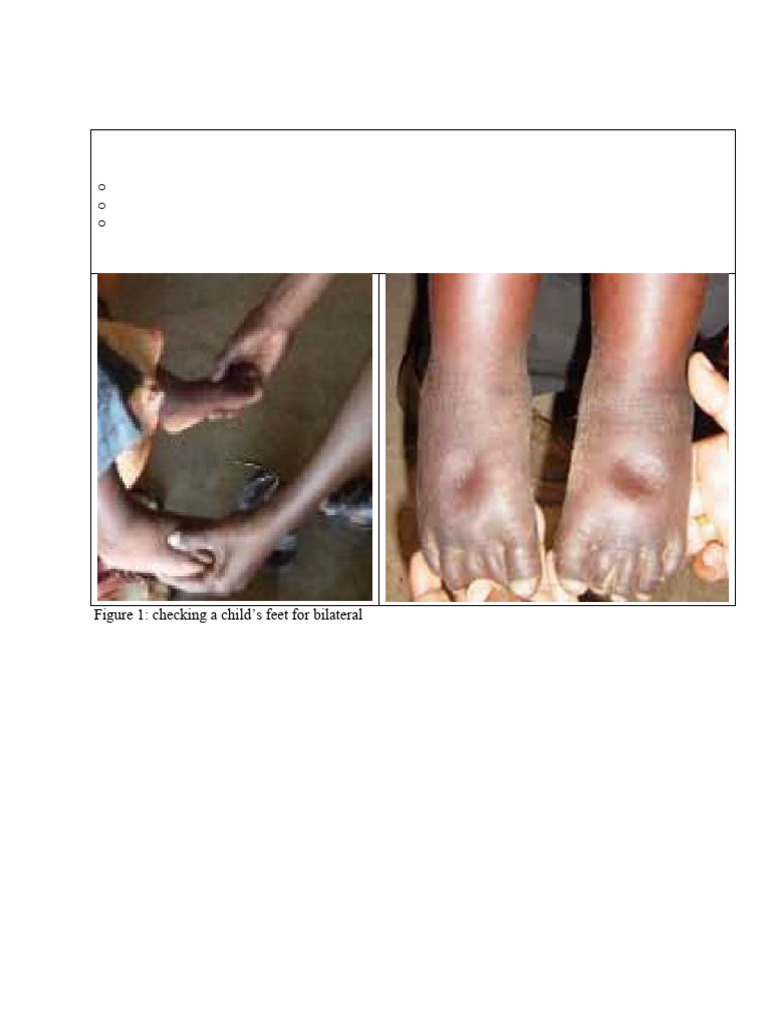 CMAM JOB AID JA1_Checking swelling of both feet | PDF