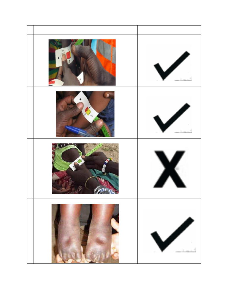 CMAM JOB AID JA-3- determining action to take based on MUAC and ...