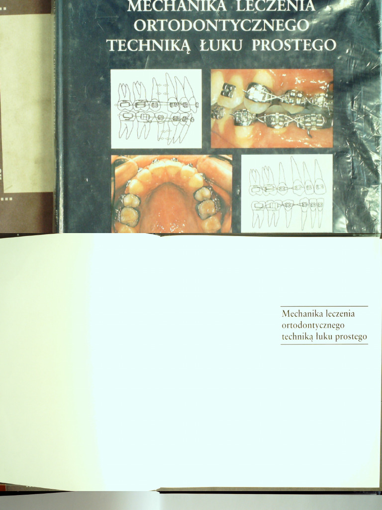 Mechanika Leczenia Ortodontycznego Techniką Łuku Prostego Bennett | PDF