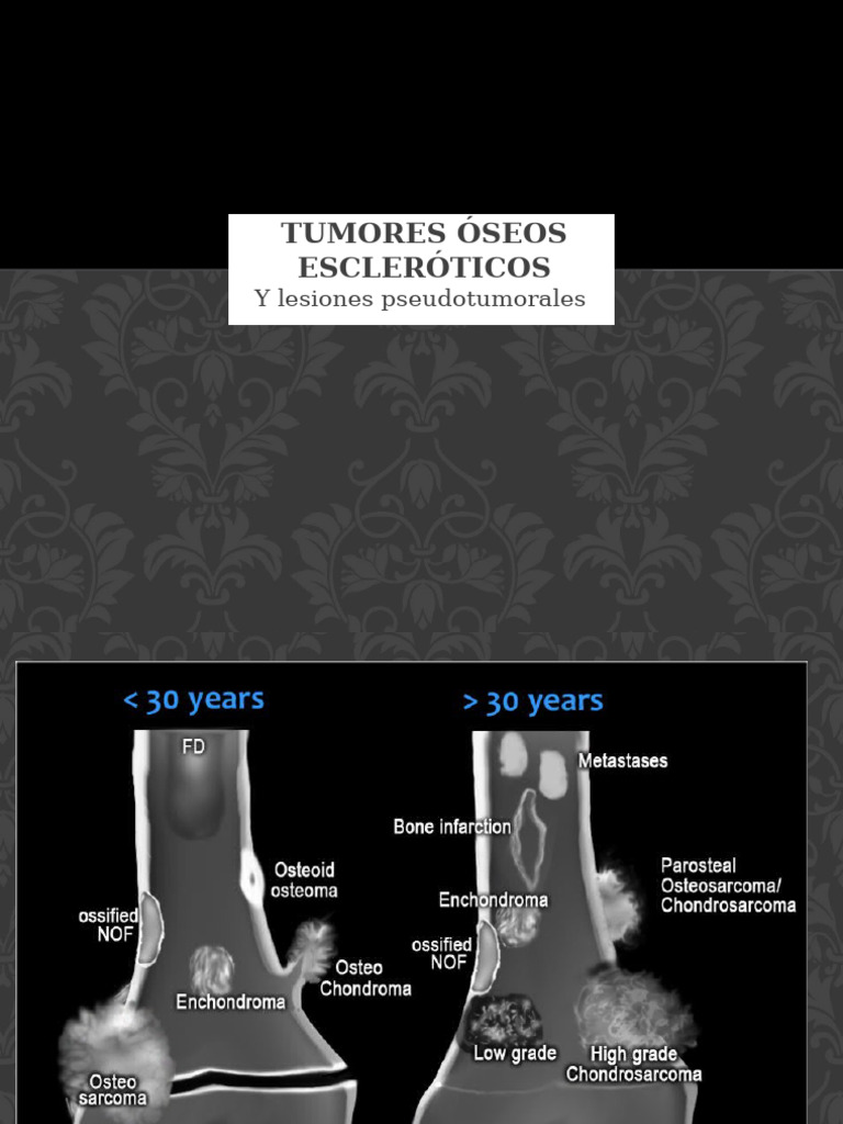 Tumores Óseos Escleróticos | PDF | Hueso | Metástasis