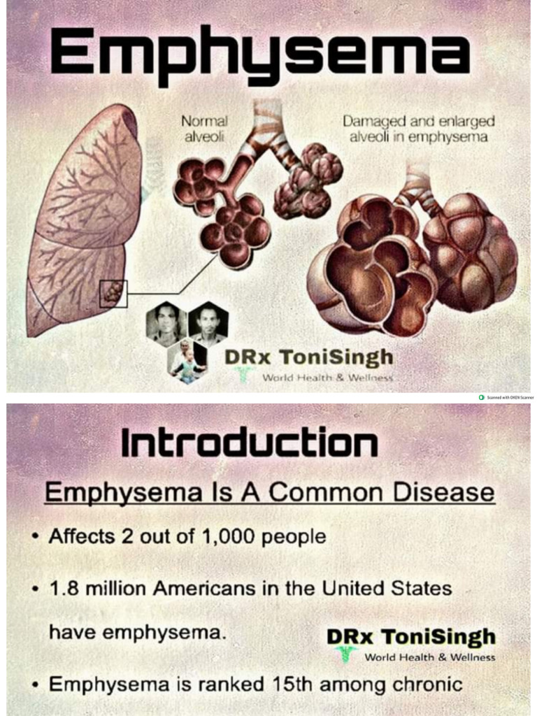 Emphysema | PDF