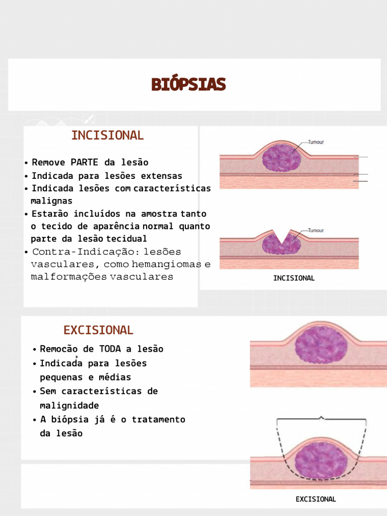 Tipos de Biópsias: Incisional e Excisional | PDF