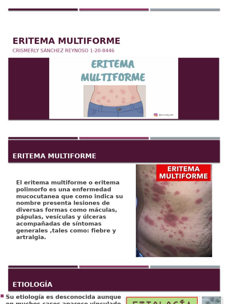Eritema Multiforme: Síntomas y Tratamiento | PDF