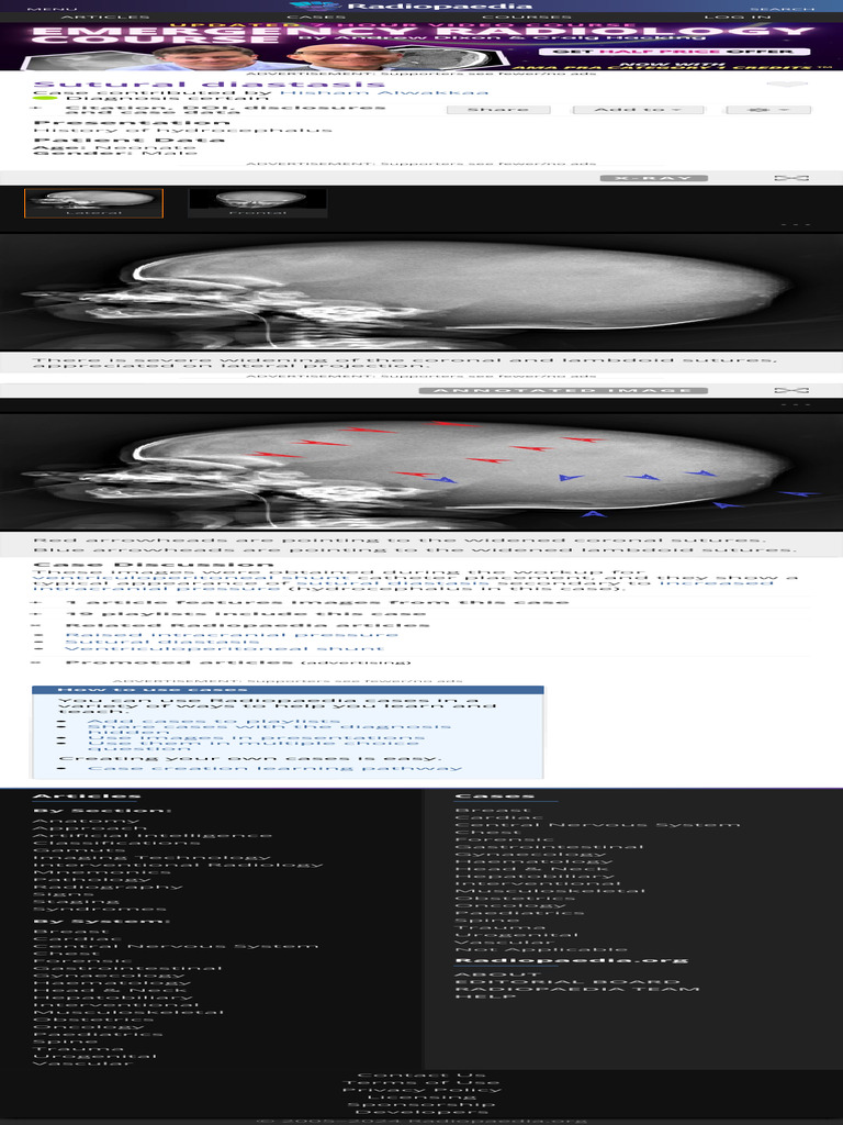 Sutural Diastasis in Hydrocephalus Case | PDF | Radiology | Medical ...