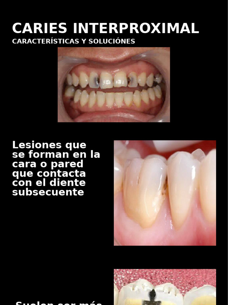 Caries Interproximal | PDF