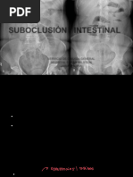 Suboclusion Intestinal | PDF | Enfermedades digestivas | Gastroenterología