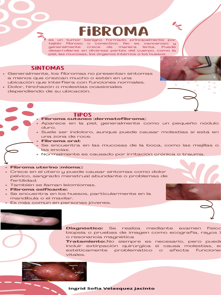 Tipos y Tratamiento de Fibromas | PDF