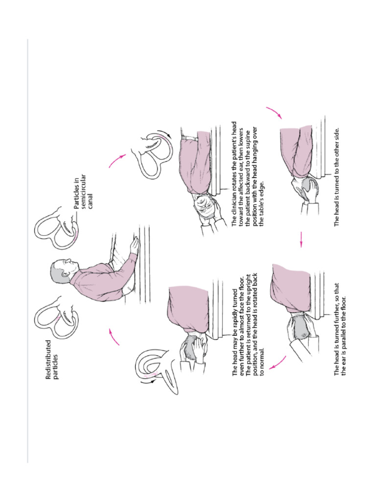 Epley maneuver | PDF
