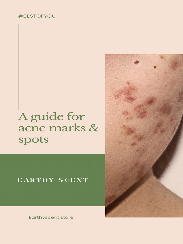 Acne Marks Guide | PDF