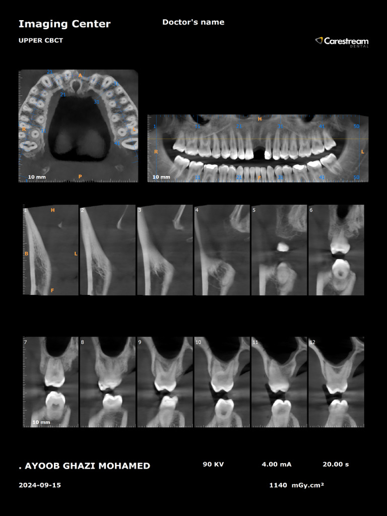 Ayoob Ghazi Upper CBCT | PDF