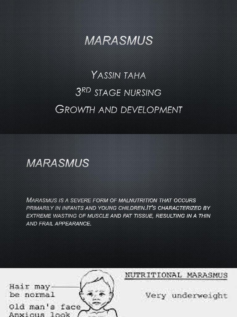 Understanding Marasmus in Children | PDF | Malnutrition | Breastfeeding