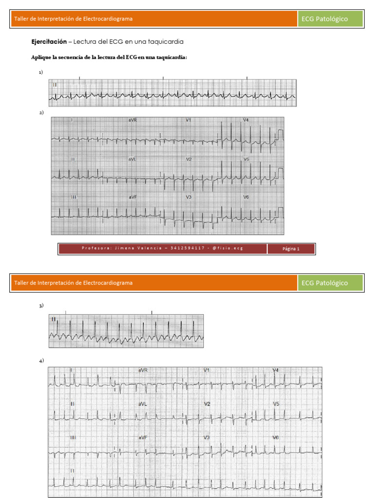 Ejercitación 3 - Secuencia de Lectura Del ECG en Una Taquicardia | PDF