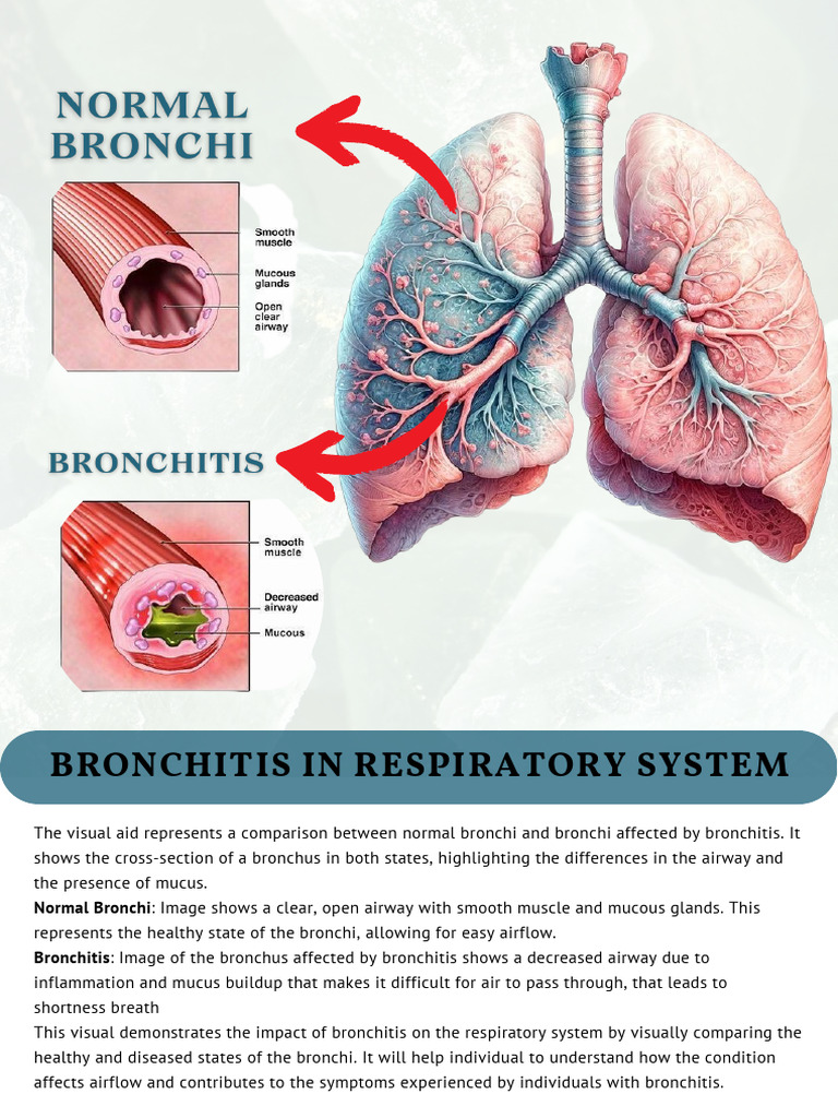 Bronchitis vs. Normal Bronchi Comparison | PDF