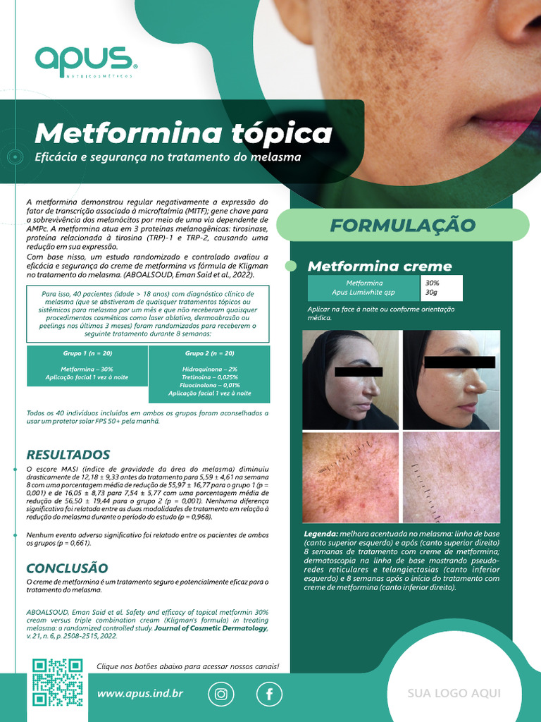 Metformina Tópica Vs Fórmula de Kligman No Tratamento Do Melasma | PDF