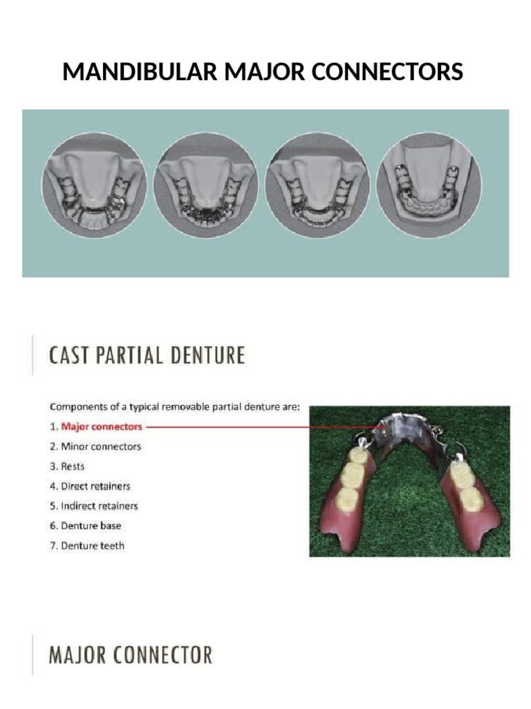 Mandibular Major Connectors 250969931 | PDF