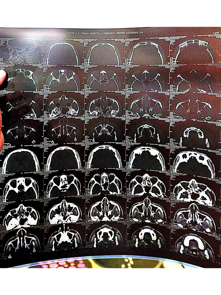 Sinuses Reports | PDF