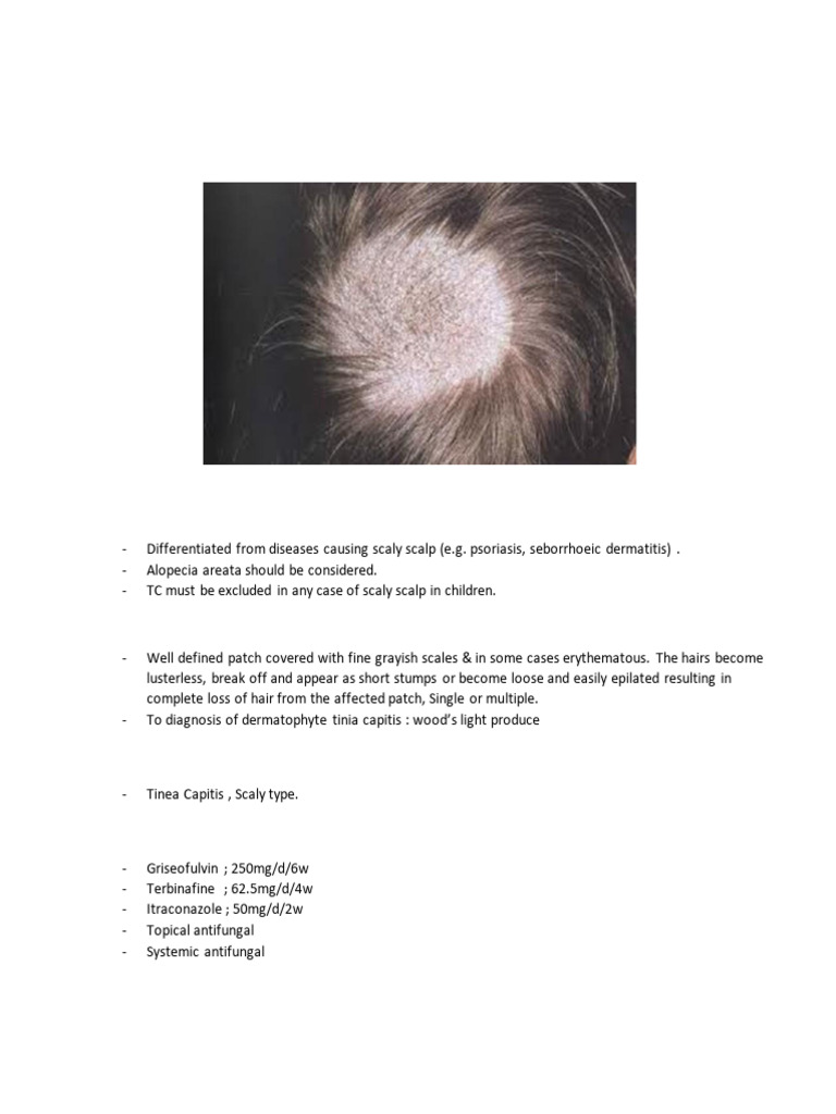 Tinea Capitis Diagnosis & Treatment | PDF