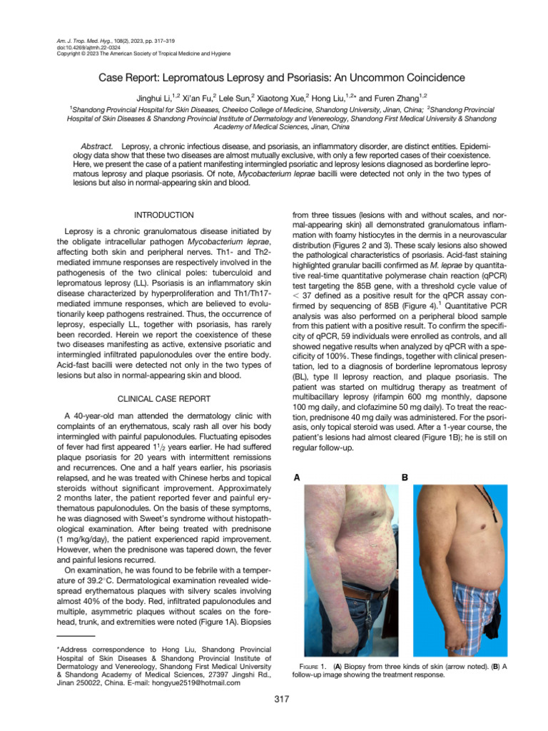 Case Report - Lepromatous Leprosy and Psoriasis - An Uncommon ...