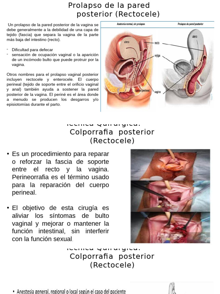 Colporrafia Posterior (Rectocele) | PDF | Cirugía | Vagina