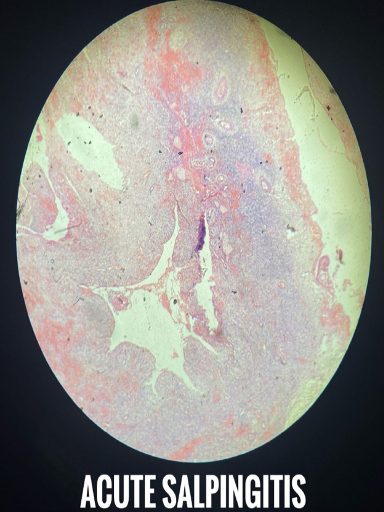 Patho-Acute Salpingitis, Chronic Cholecystitis | PDF