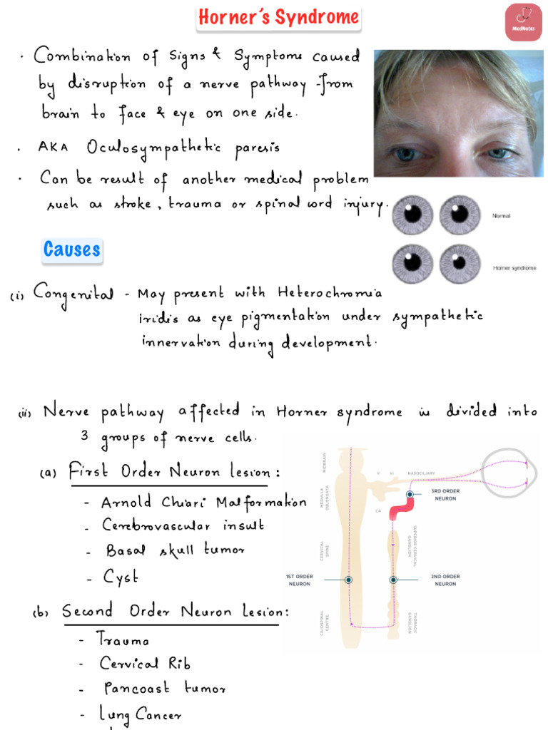 Horner’s Syndrome | PDF | Nervous System | Medical Specialties