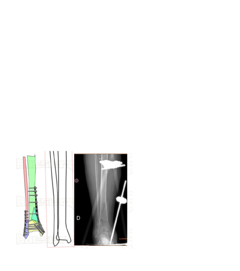 Pilon Tibial | PDF