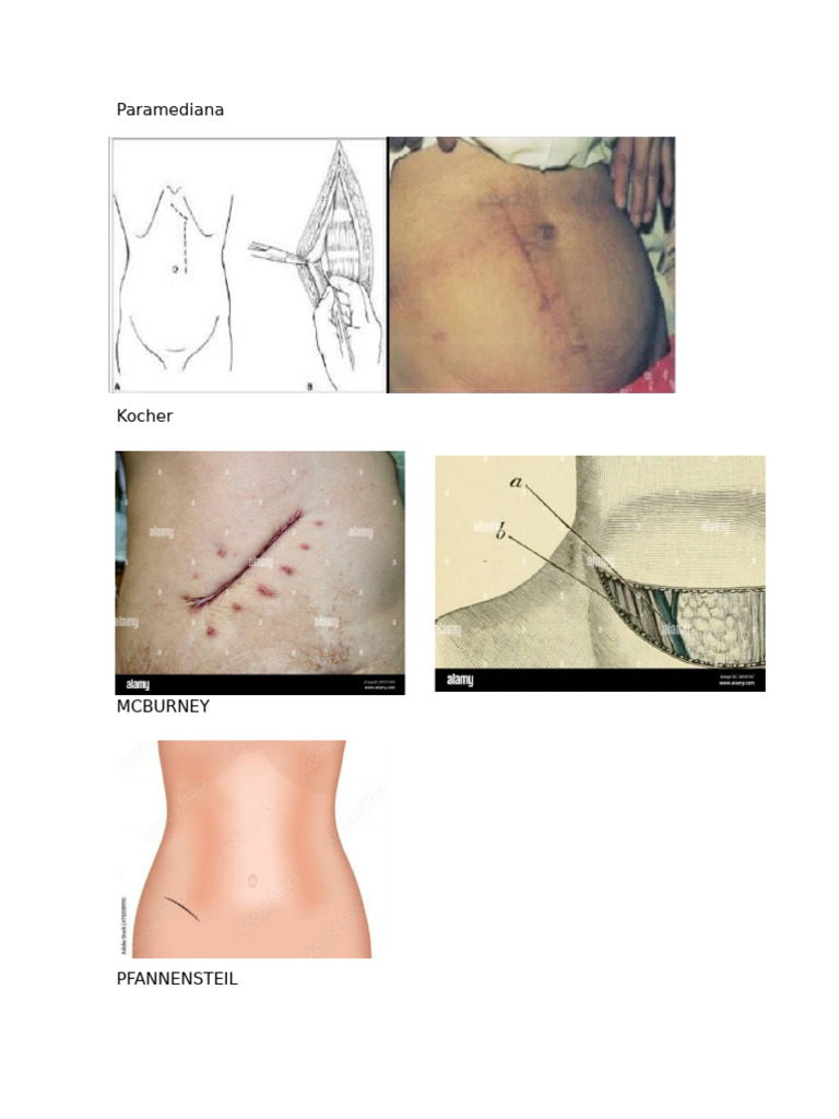 Tipos de Incisiones | PDF