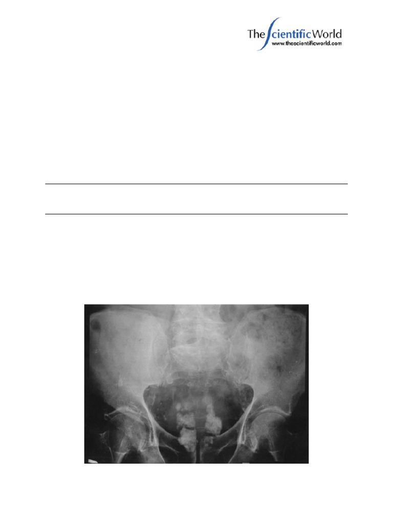 Prostatic Calculi and Bladder Obstruction | PDF | Prostate | Urology