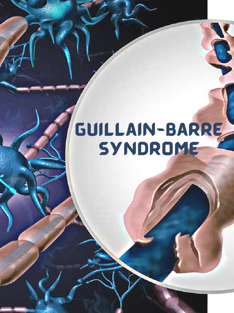 Guillain-Barré Syndrome | PDF | Clinical Medicine | Nervous System
