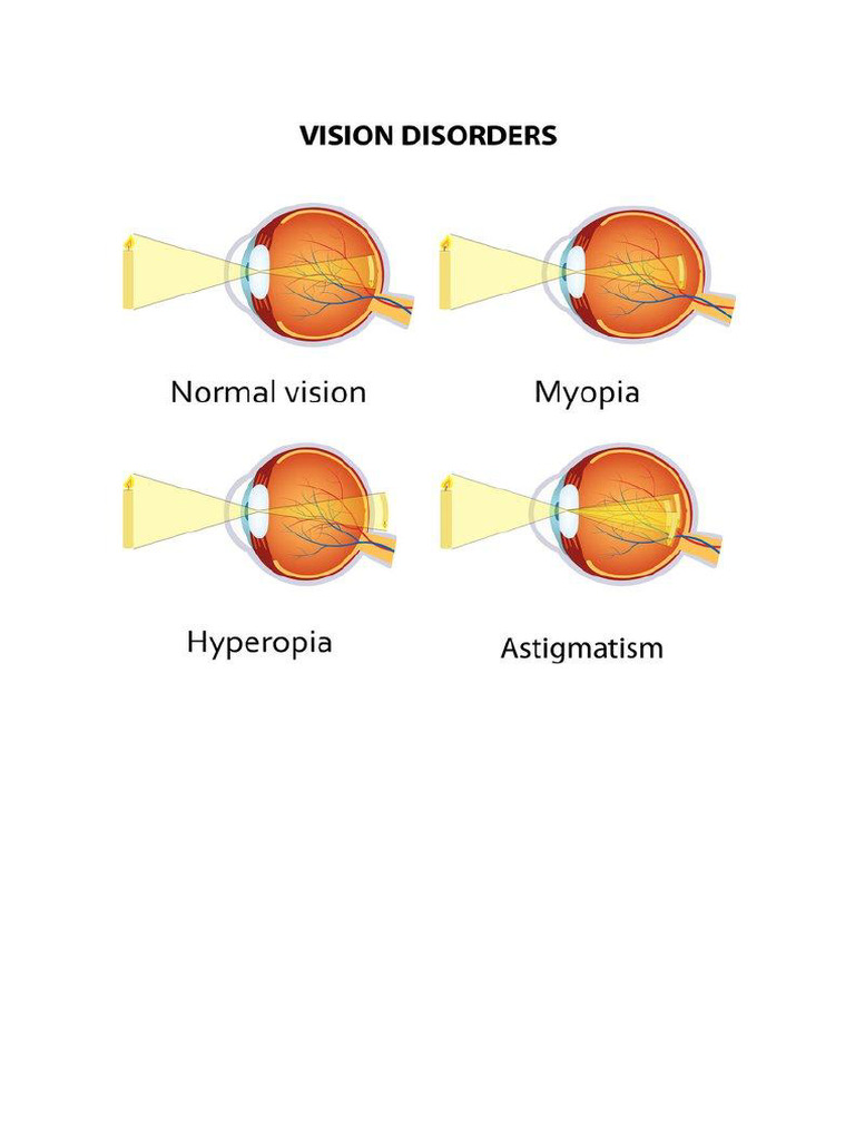 Vision Disorder and Eye Prescription | PDF