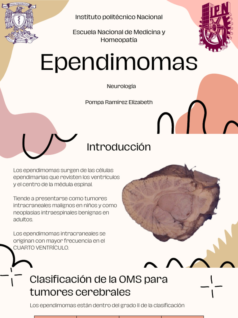 Ependimomas Neuro - 20250106 - 201310 - 0000 | PDF | Terapia | Neoplasias