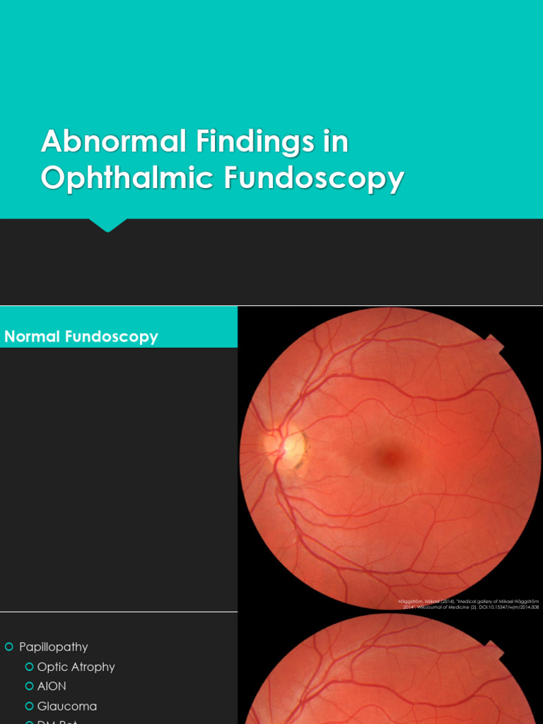 ophtha_abn fundoscopy | PDF | Ophthalmology | Human Eye