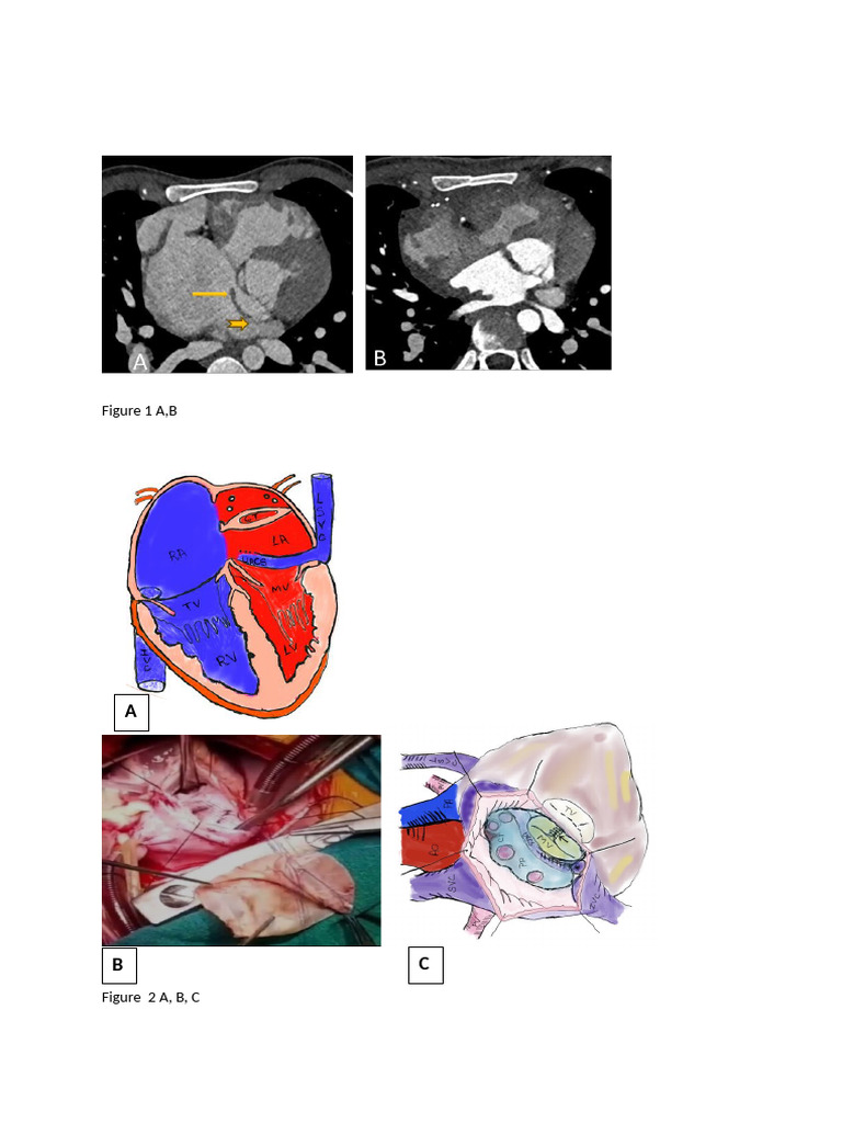 Cardiac CT Angiography: Atrial Septal Defect Repair | PDF