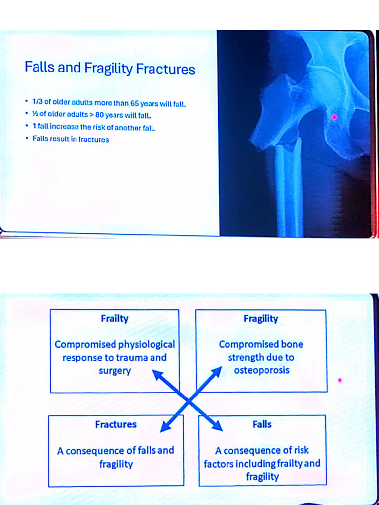 Fragility Fractures | PDF