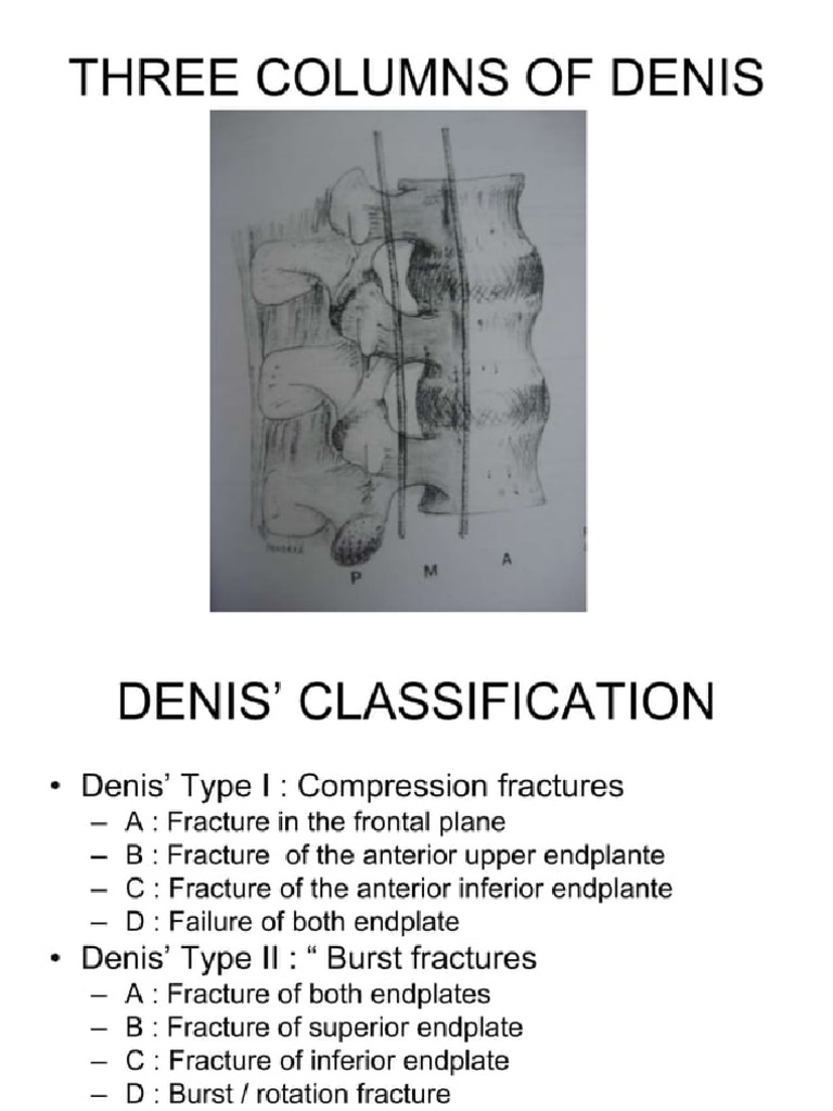 Classification and Treament Fracture of The Spine - 20240402 - 233022 | PDF