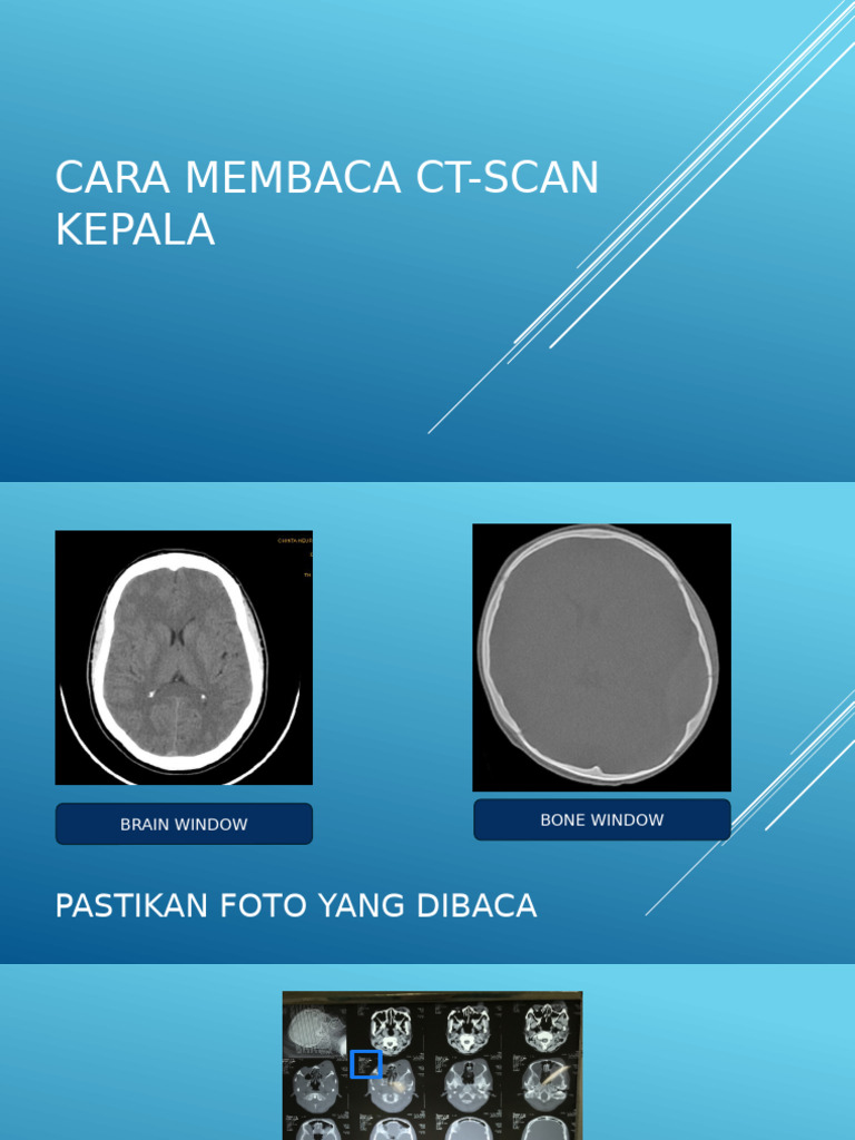 -Cara-Membaca-Ct-scan-Kepala | PDF