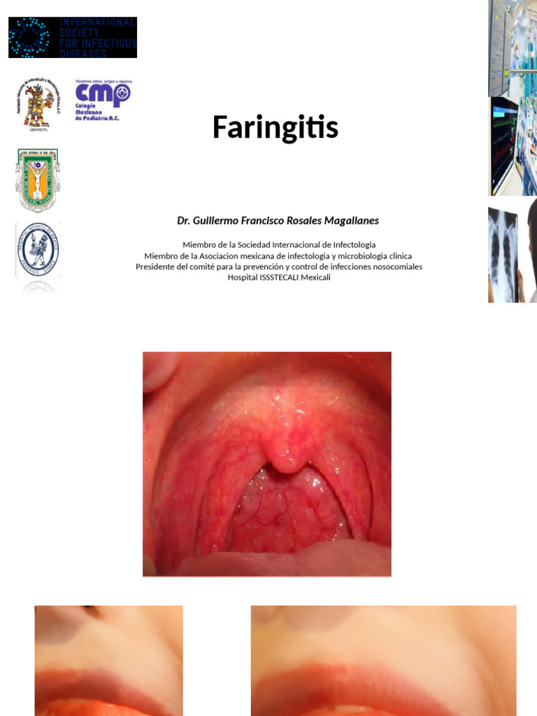 faringitis | PDF