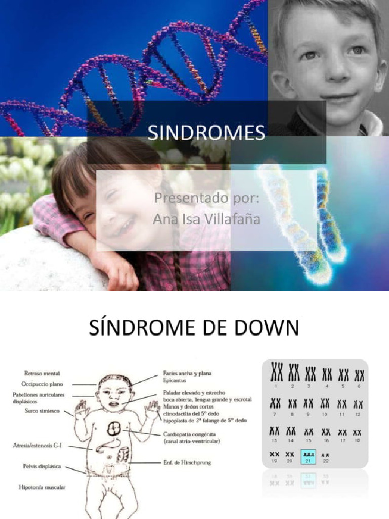 Sindrome de Down Patau Edwards Klinefelter Turner Praderwilli y Russell ...