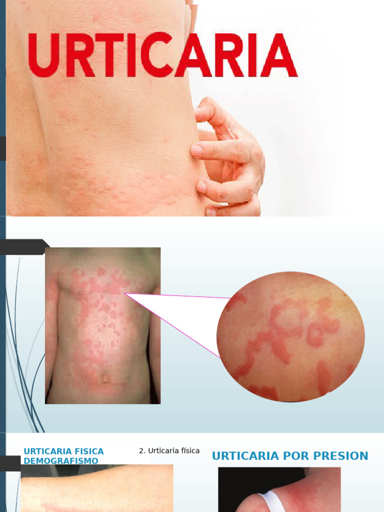 Urticaria | PDF