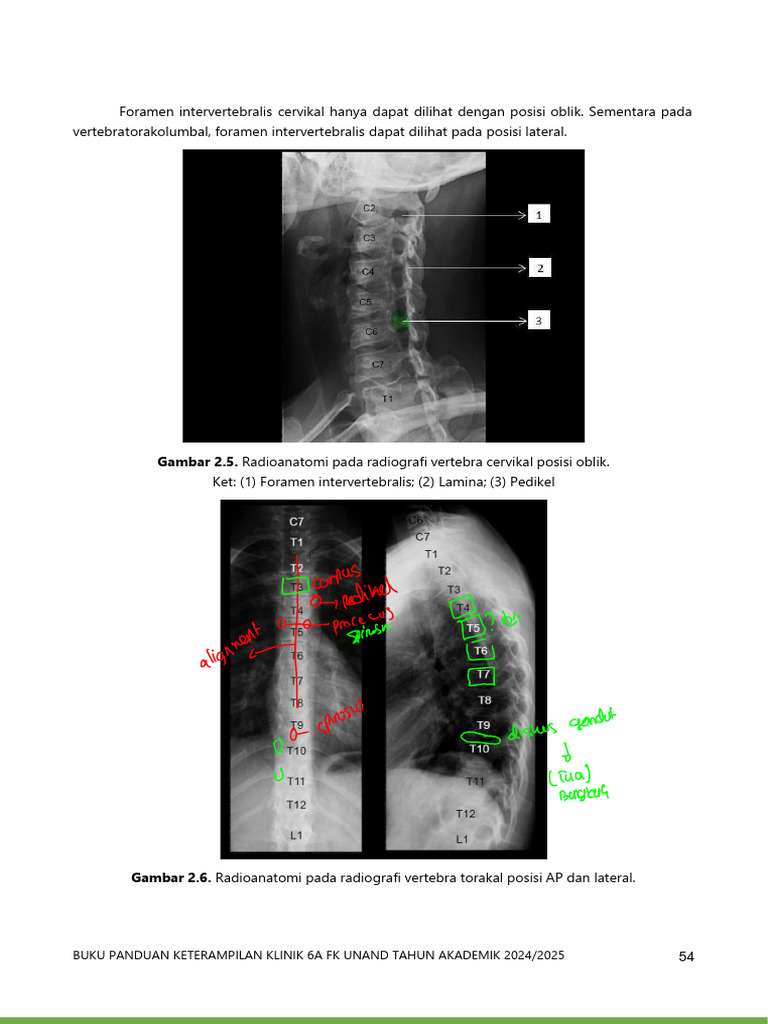 Radioanatomi Foramen Intervertebralis | PDF