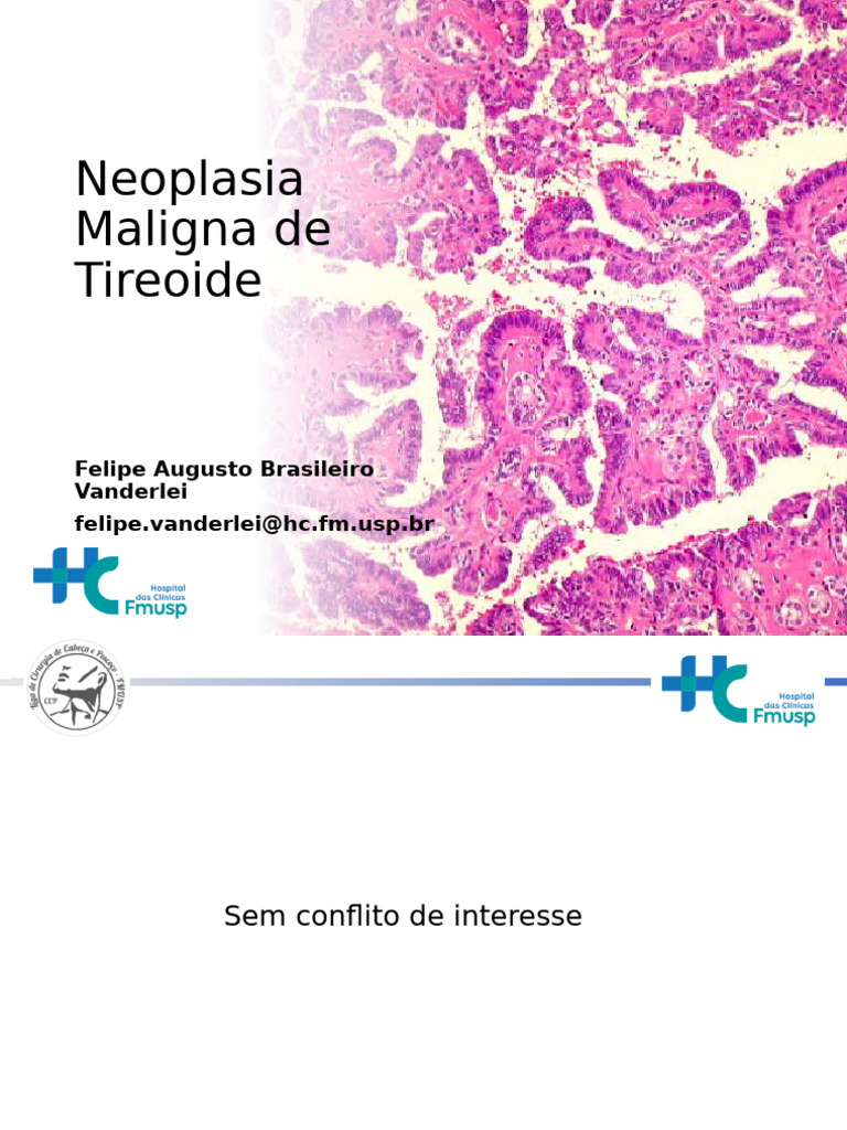 Neoplasia Maligna de Tireoide: Diagnóstico e Tratamento | PDF