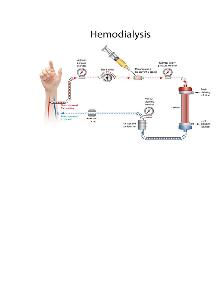 hemodialysis | PDF