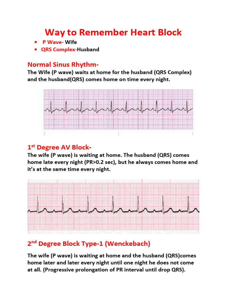 Heart Block | PDF