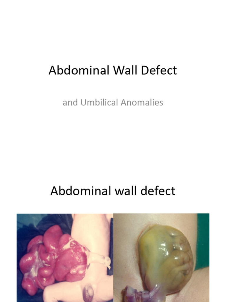 Abdominal Wall Defect - Inter PED67 | PDF