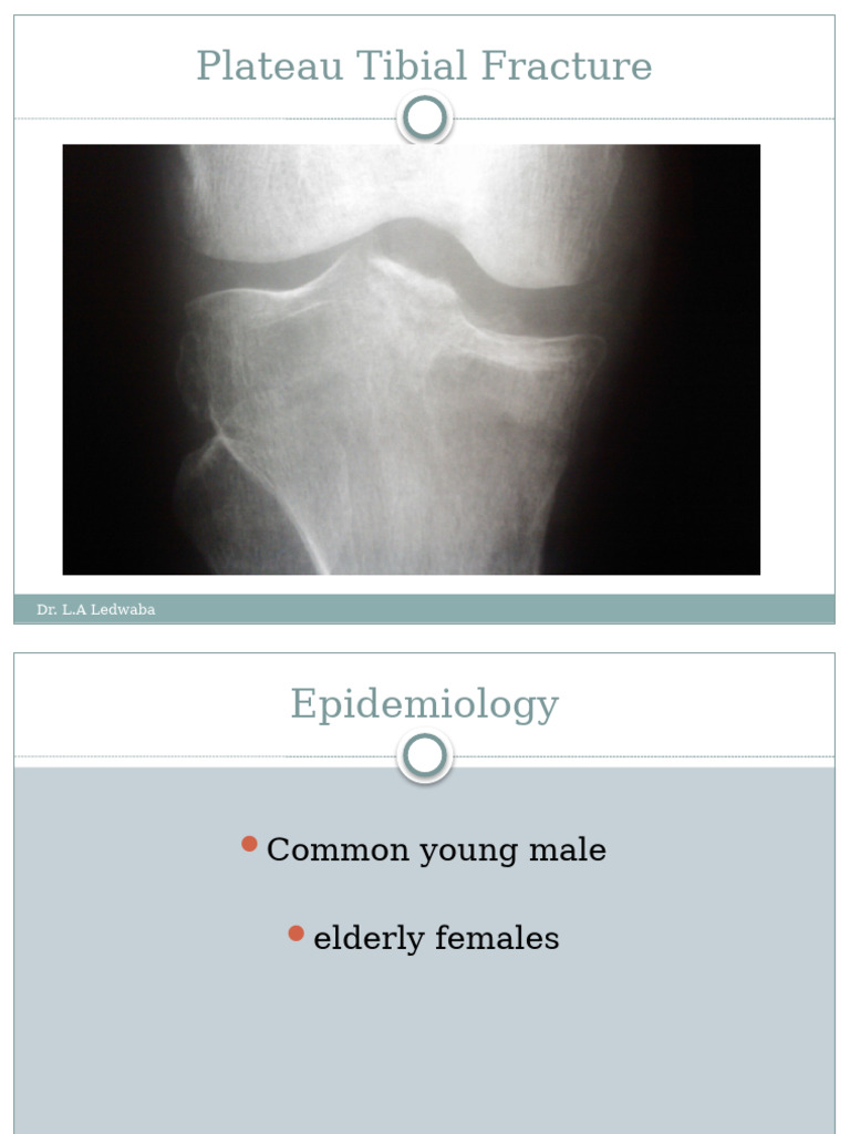 Tibial Fracture Insights for Clinicians | PDF | Musculoskeletal System ...