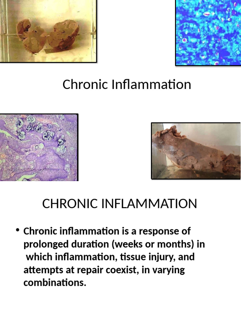 Understanding Chronic Inflammation and TB | PDF | Tuberculosis ...