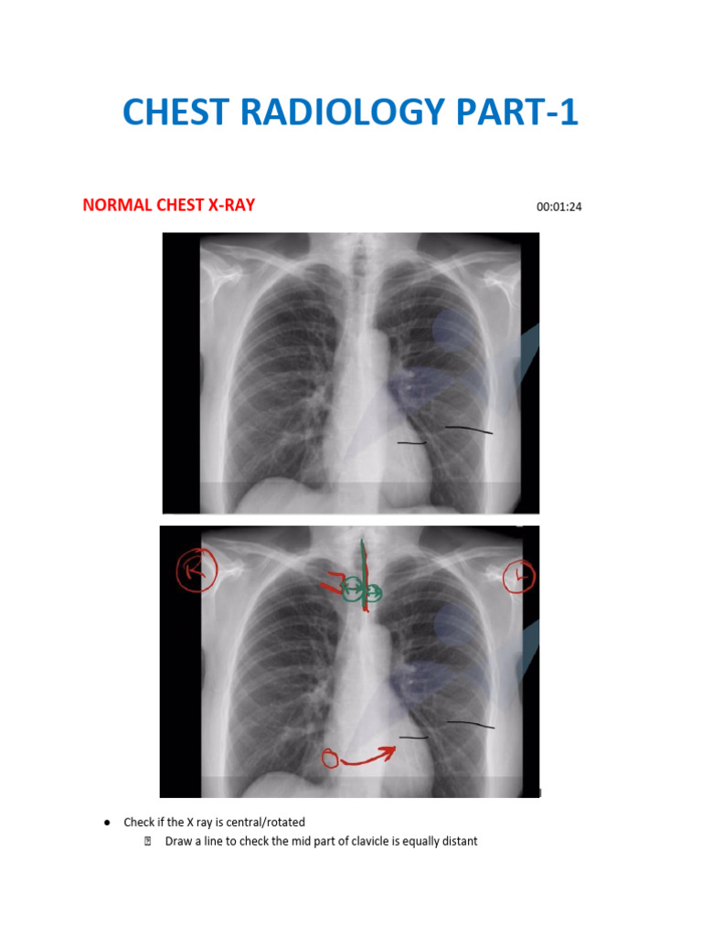 Normal Chest X-Ray Interpretation | PDF | Lung | Thorax